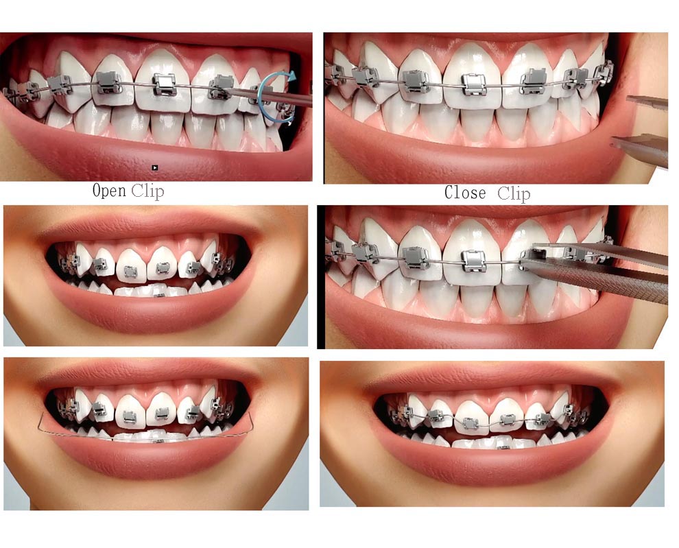 4D® Slim Slide Passive Self-Ligating Bracket (Include ligating ...